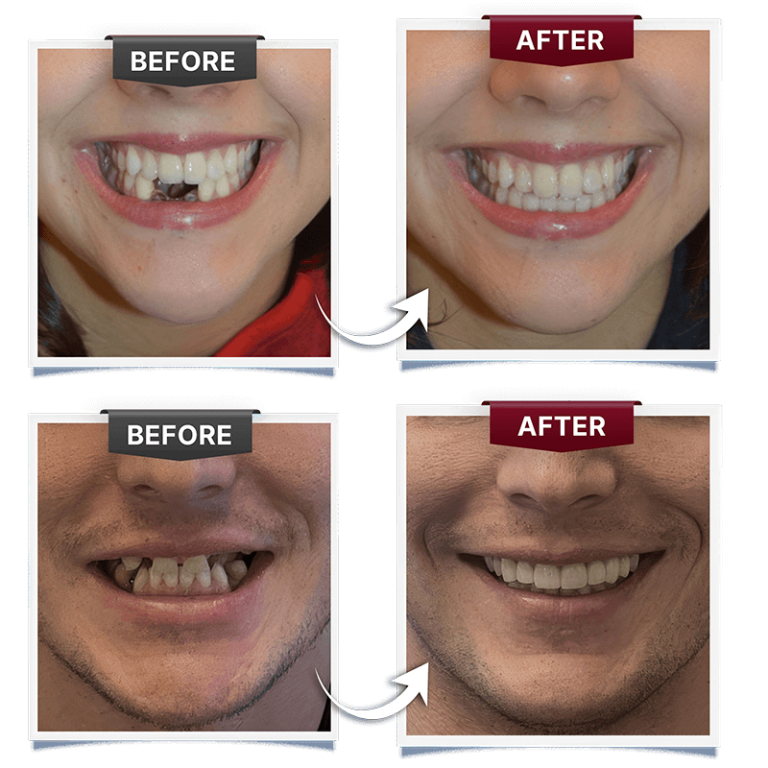 Worried About Your Dental Crown Falling Off? Here’s How to Prevent It ...